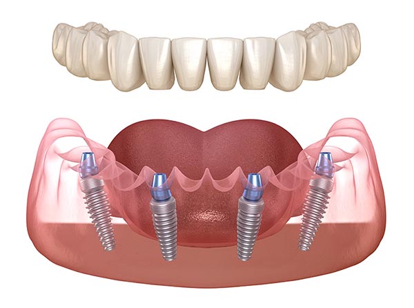 All on 4 Dental Implants Spring, TX | Vibe Dentistry